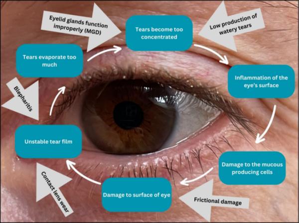 Symptoms and causes - Dry Eye Clinic providing Dry Eye Treatment